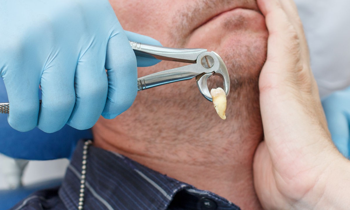 How Long Does Wisdom Teeth Removal Take - The Wisdom Teeth Guru